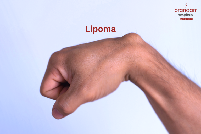 Understanding Lipoma: Causes, Symptoms, and Treatment - Pranaam Hospitals
